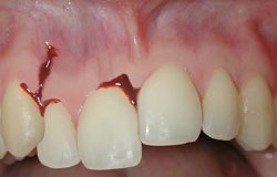 Fracture injury: Alveolar fracture – Dental Trauma Guide