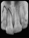 Fracture injury: Alveolar fracture – Dental Trauma Guide