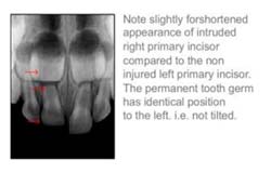 treatment-1 – Dental Trauma Guide