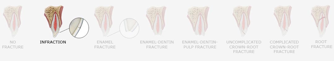 Lateral Luxation Dental Trauma Guide – UWJT