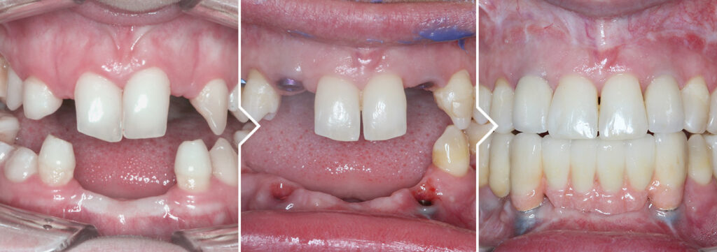 Tooth Agenesis Webinar – Dental Trauma Guide