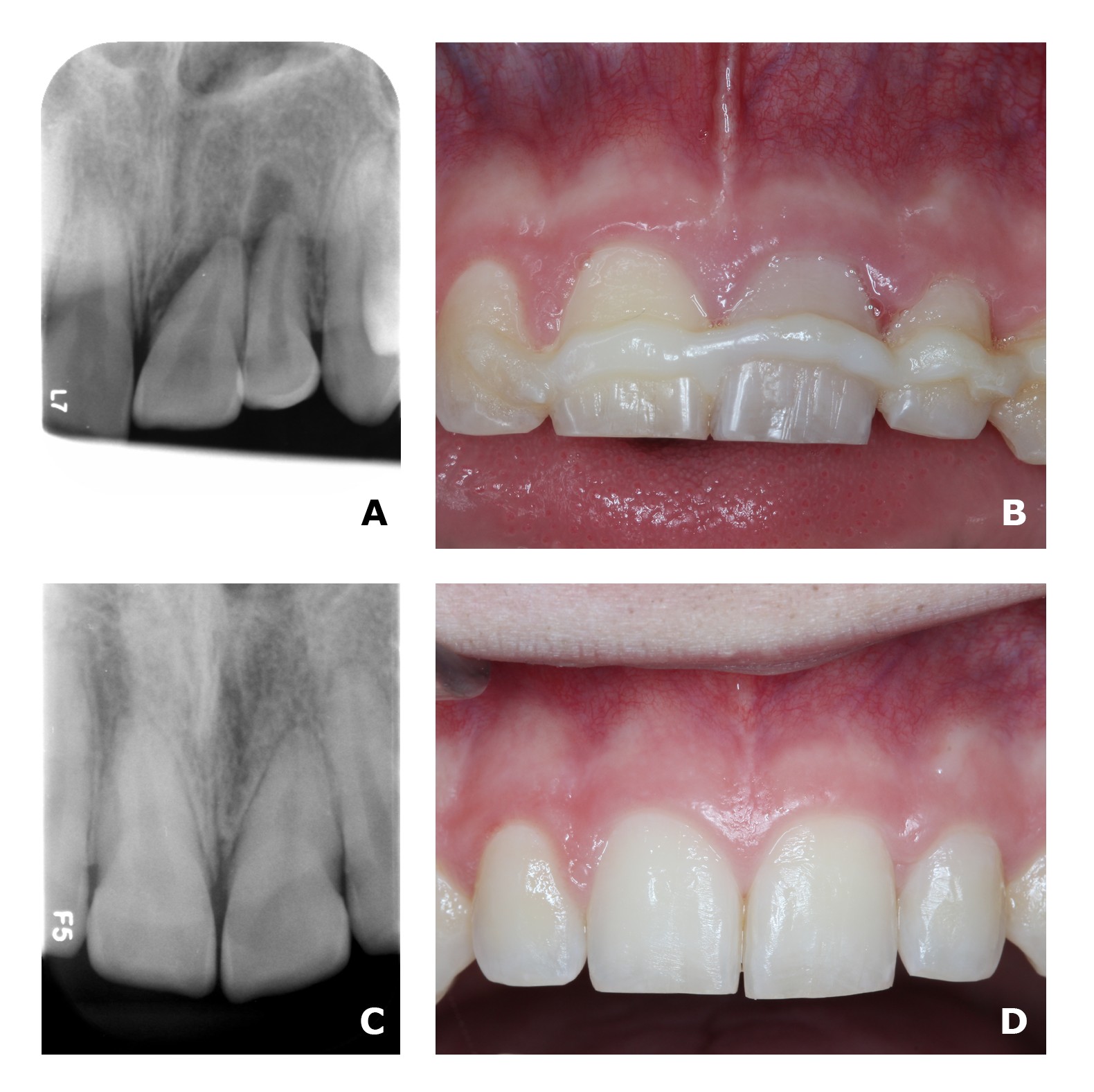 Potential for Pulp Revascularization in Mature Anterior Teeth with ...